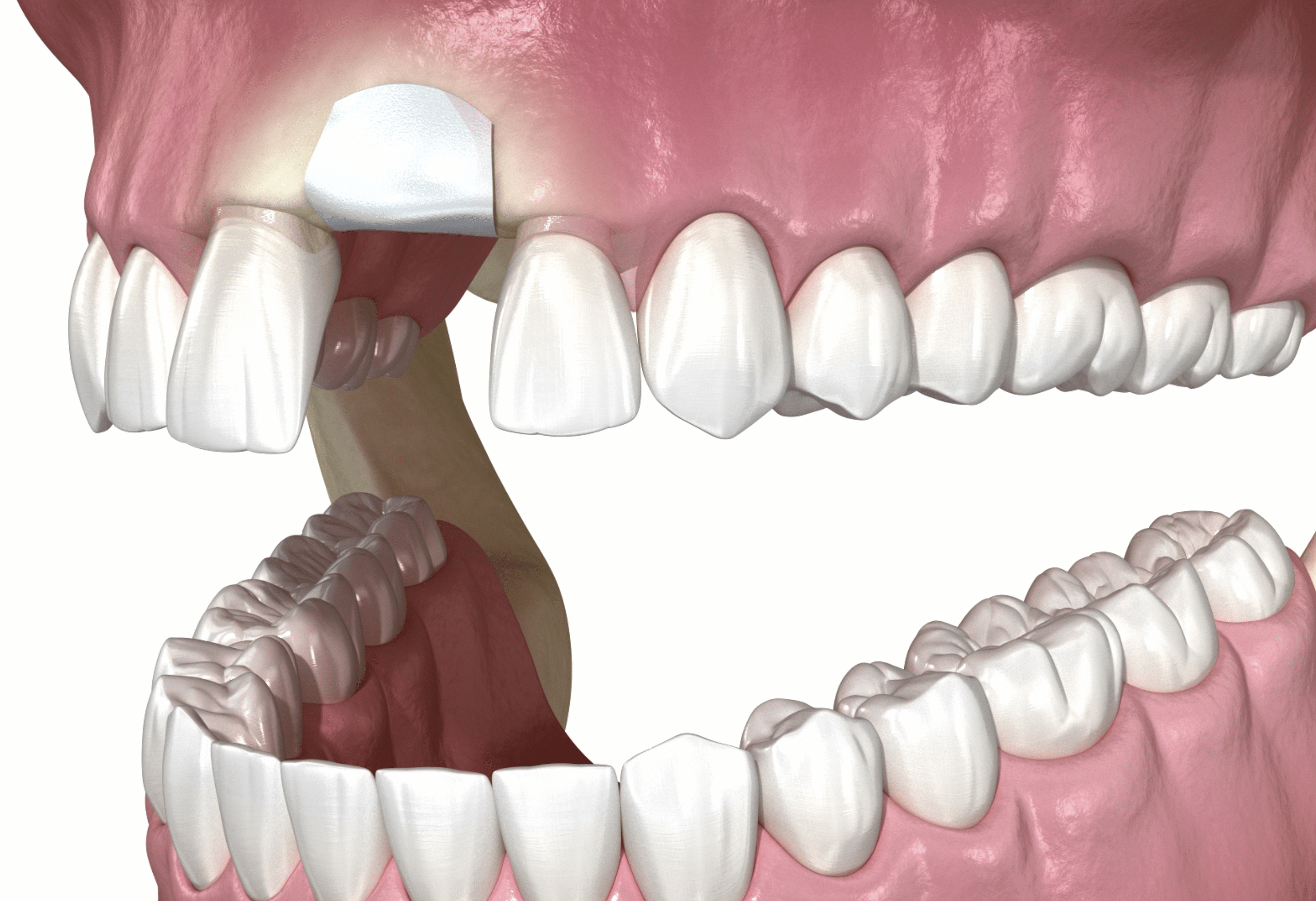 Dental Office - Dental Implants with Bone graft and membrane